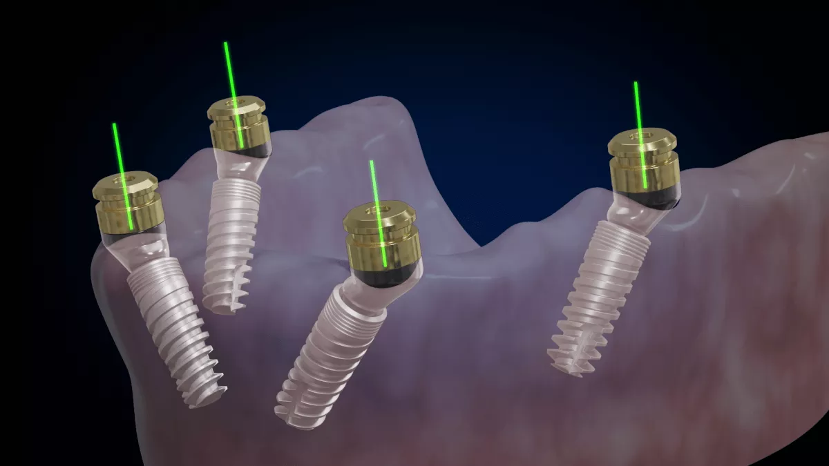 Tele-Magnetic Abutments – ABraCadabra